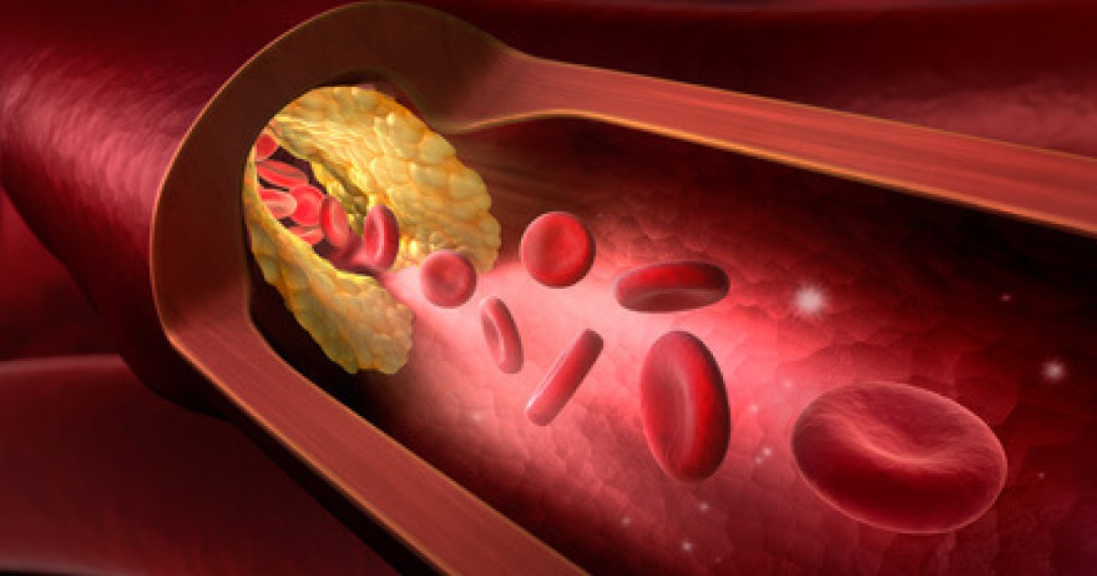Bypass-OP - Notwendigkeit, Vorgehen, Risiken und Reha