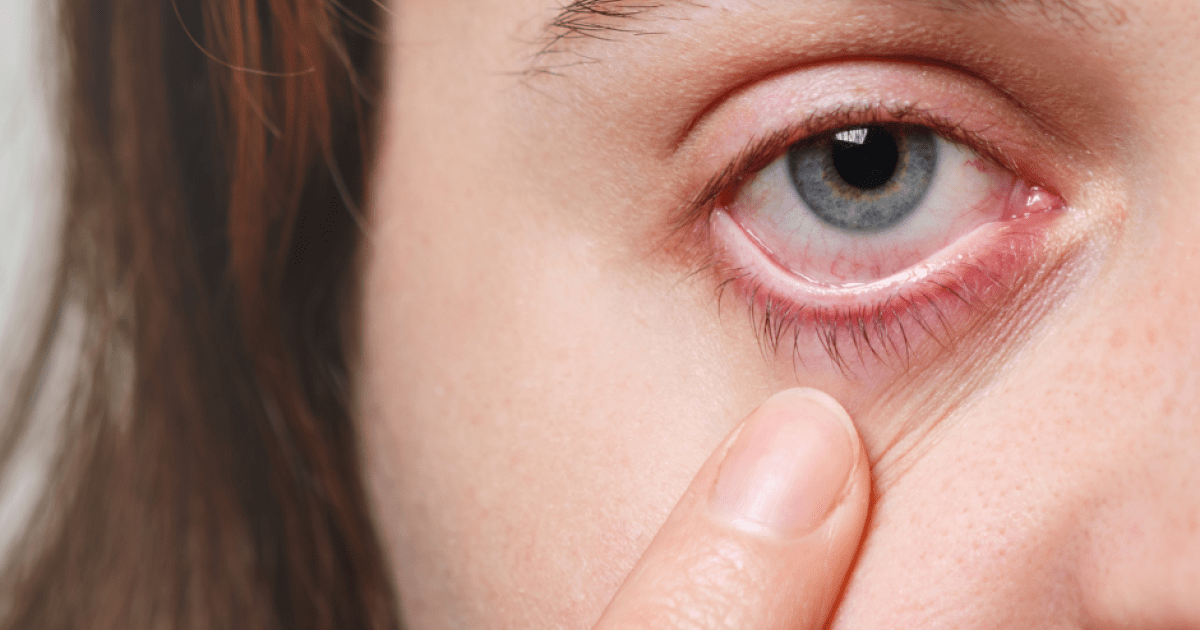 Rheumatische Erkrankung Sjögren Syndrom - „Sicca Syndrom“